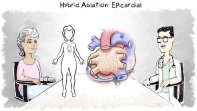 Minimally Invasive Ablation | Atrial Fibrillation Treatment